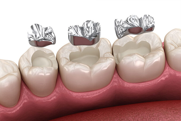 SAFE Amalgam Removal | The Woodlands, TX | Dental Specialists & Implant ...